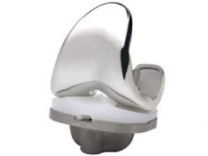 Zimmer Persona Knee Replacement FAQ | Zimmer Knee Class Action